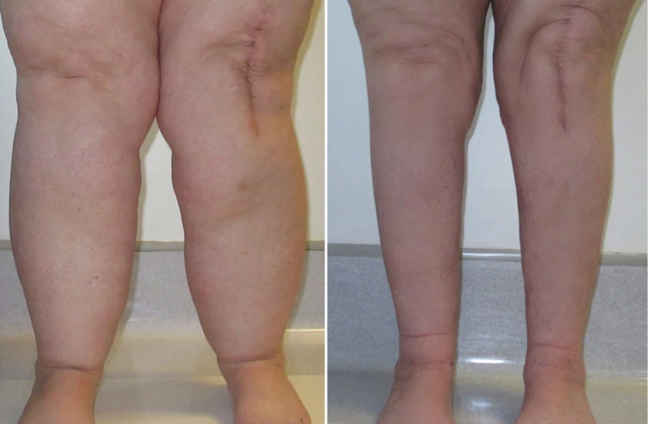 Lipedema - Phoenix Healhty